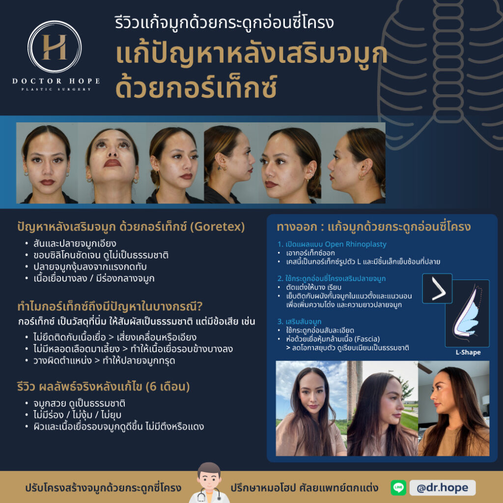 รีวิวแก้จมูกด้วยกระดูกอ่อนซี่โครง หลังเสริมกอร์เท็กซ์ - Beauty Med Hub